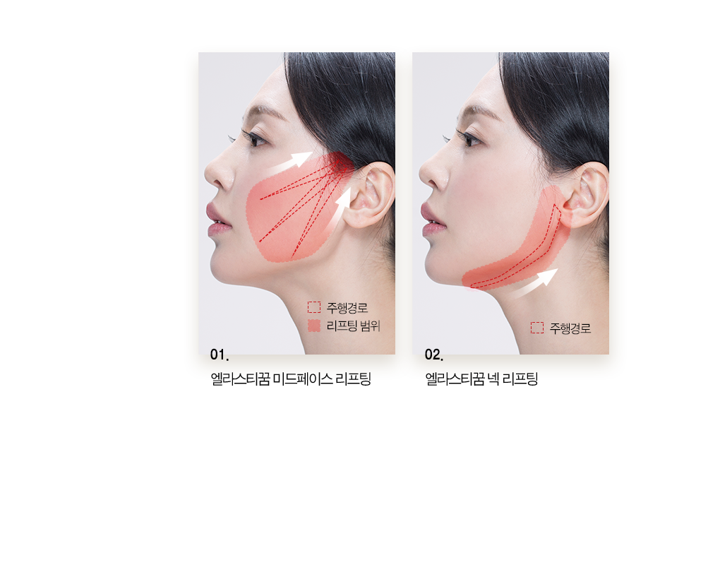 투비성형외과의원 리프팅 비절개 리프팅